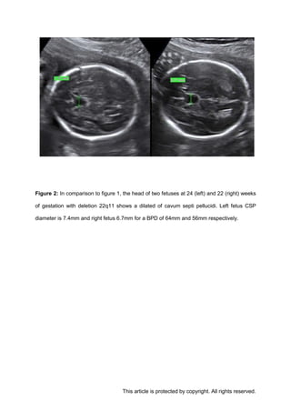 Chaoui 2016 csp 22q11 giãn khoang vách trong suốt | PDF