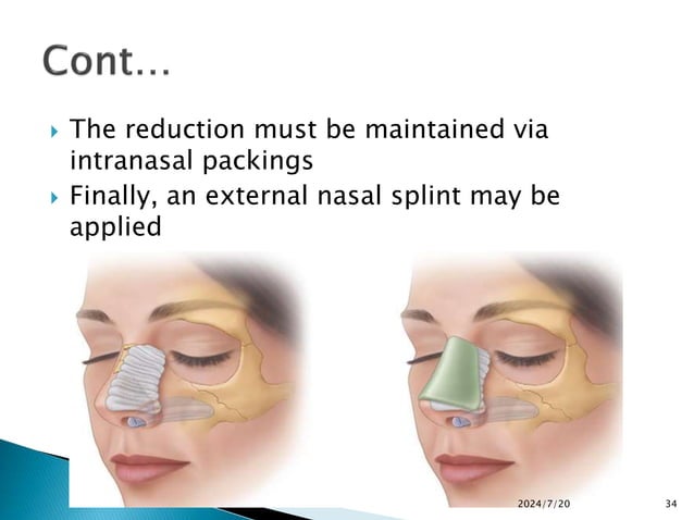 Chap 3d Fracture Of Nasal Bone Maxillofacial Surgery Pptx