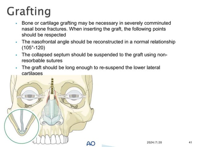 chap-3d fracture of nasal bone maxillofacial surgery.pptx