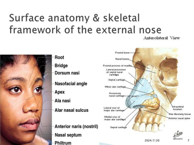 chap-3d fracture of nasal bone maxillofacial surgery.pptx