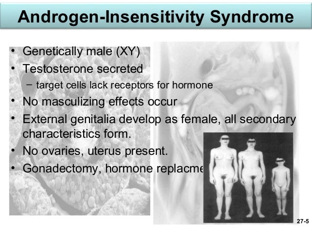 Turner syndrome as related to Androgen insensitivity syndrome - Pictures