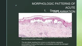 Inflammation- acute and chronic pathology | PPTX