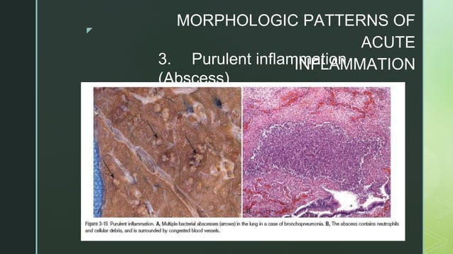 Inflammation- acute and chronic pathology | PPT