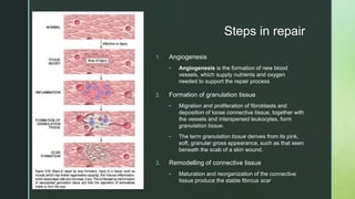 Inflammation- acute and chronic pathology | PPTX