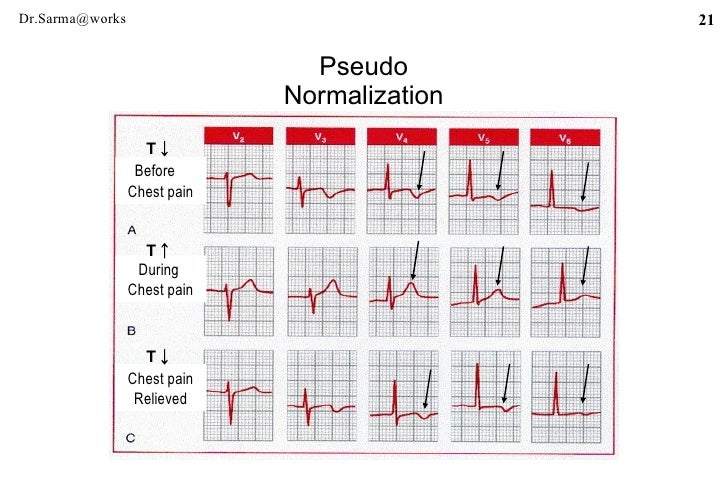 electrocardiogram