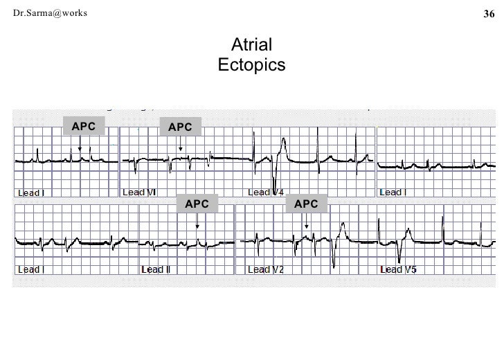 electrocardiogram