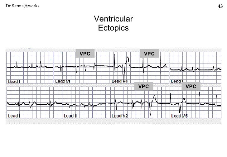 electrocardiogram