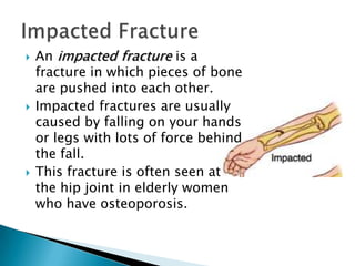 Chap 4 fractures | PPTX | Death, Injury, or Military Conflict ...