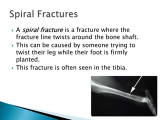 Chap 4 fractures | PPTX
