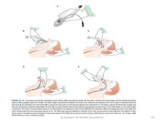 Chapter 4-introduction to airway management techniques 21(2) | PPTX