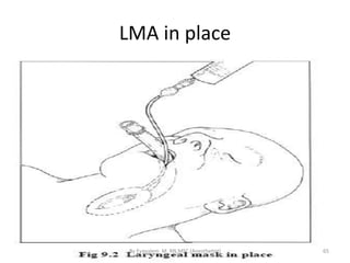 Chapter 4-introduction to airway management techniques 21(2) | PPTX