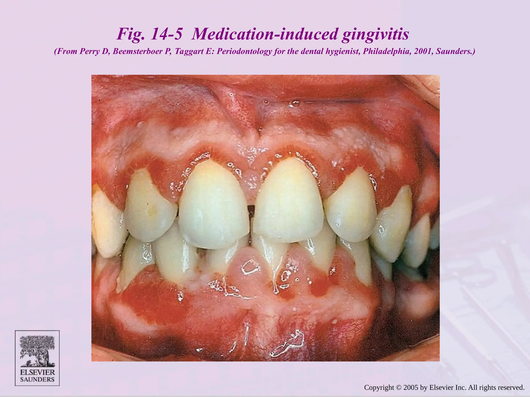 Chapter_014.ppt Periodontal diseases content | PPT