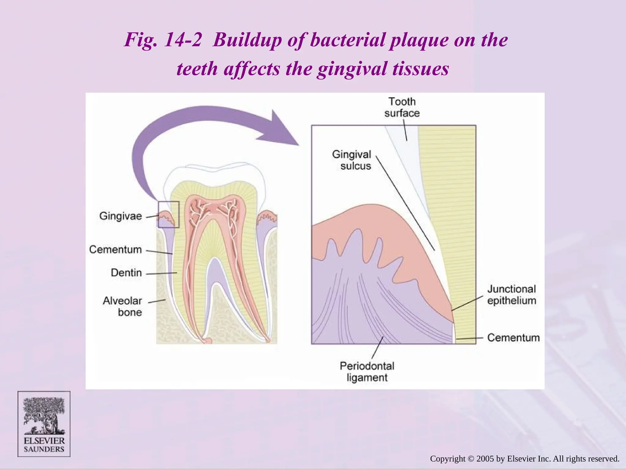 Chapter_014.ppt Periodontal diseases content | PPT