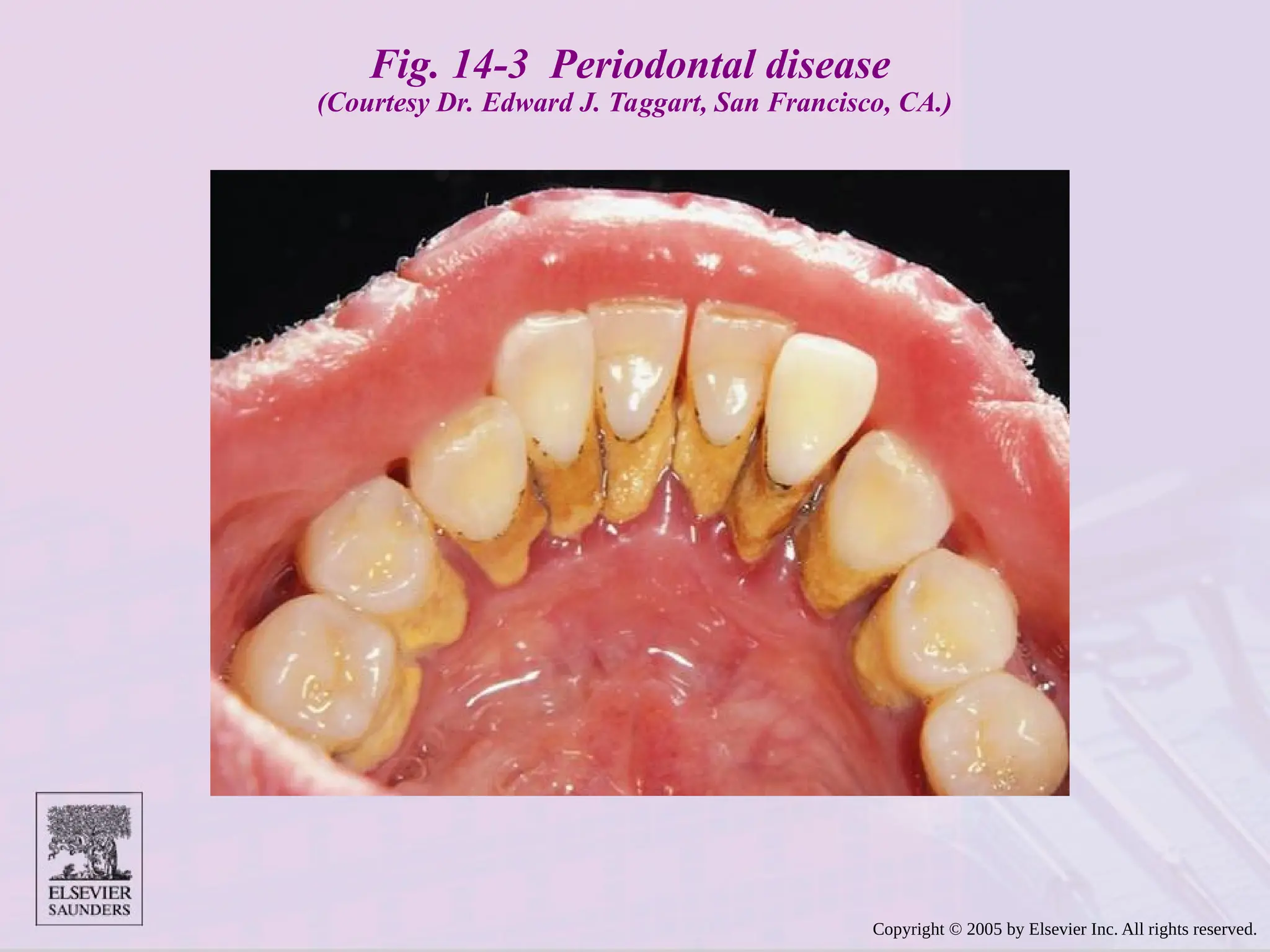 Chapter_014.ppt Periodontal diseases content | PPT