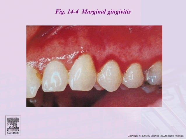 Chapter_014.ppt Periodontal diseases content | PPT