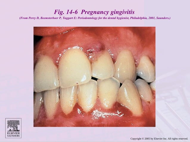 Chapter_014.ppt Periodontal diseases content | PPT