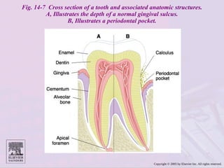 Chapter_014.ppt Periodontal diseases content | PPT