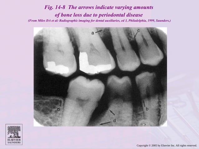 Chapter_014.ppt Periodontal diseases content | PPT
