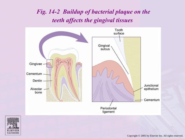 Chapter_014.ppt Periodontal diseases content | PPT