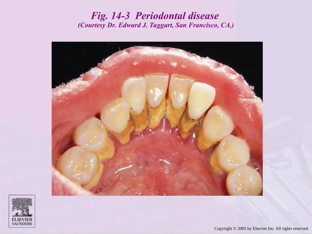 Chapter_014.ppt Periodontal diseases content | PPT