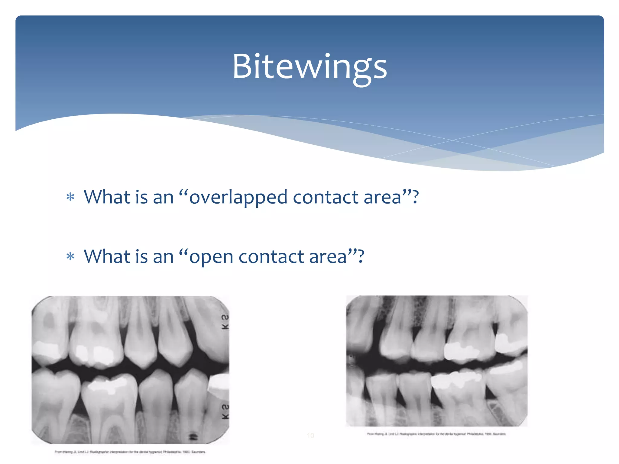 Chapter 19: Bitewing Technique | PPT