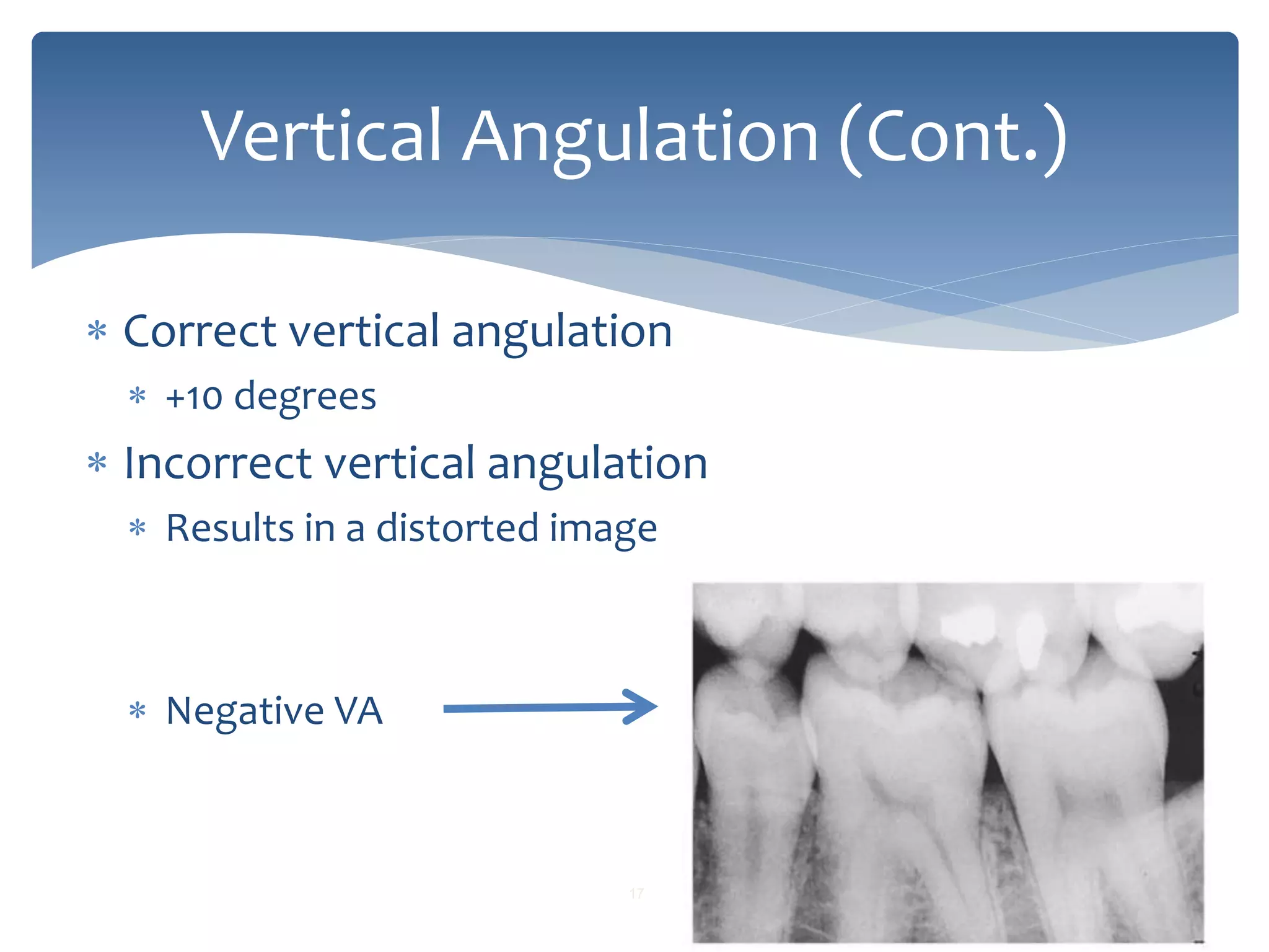 Chapter 19: Bitewing Technique | PPT