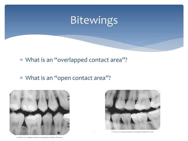 Chapter 19: Bitewing Technique | PPT | Dental Health | Diseases and ...