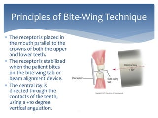 Chapter 19: Bitewing Technique | PPT
