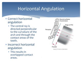 Chapter 19: Bitewing Technique | PPT