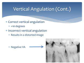 Chapter 19: Bitewing Technique | PPT | Dental Health | Diseases and ...