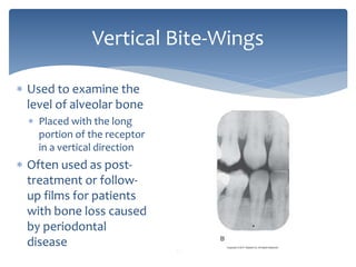 Chapter 19: Bitewing Technique | PPT