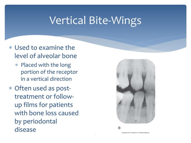 Chapter 19: Bitewing Technique | PPT | Dental Health | Diseases and ...