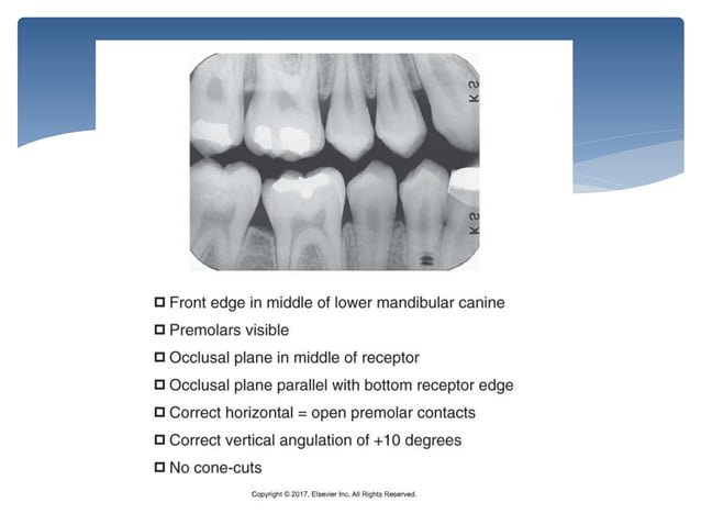 Chapter 19: Bitewing Technique | PPT | Dental Health | Diseases and ...