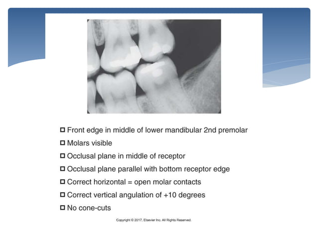 Chapter 19: Bitewing Technique | PPT | Dental Health | Diseases and ...