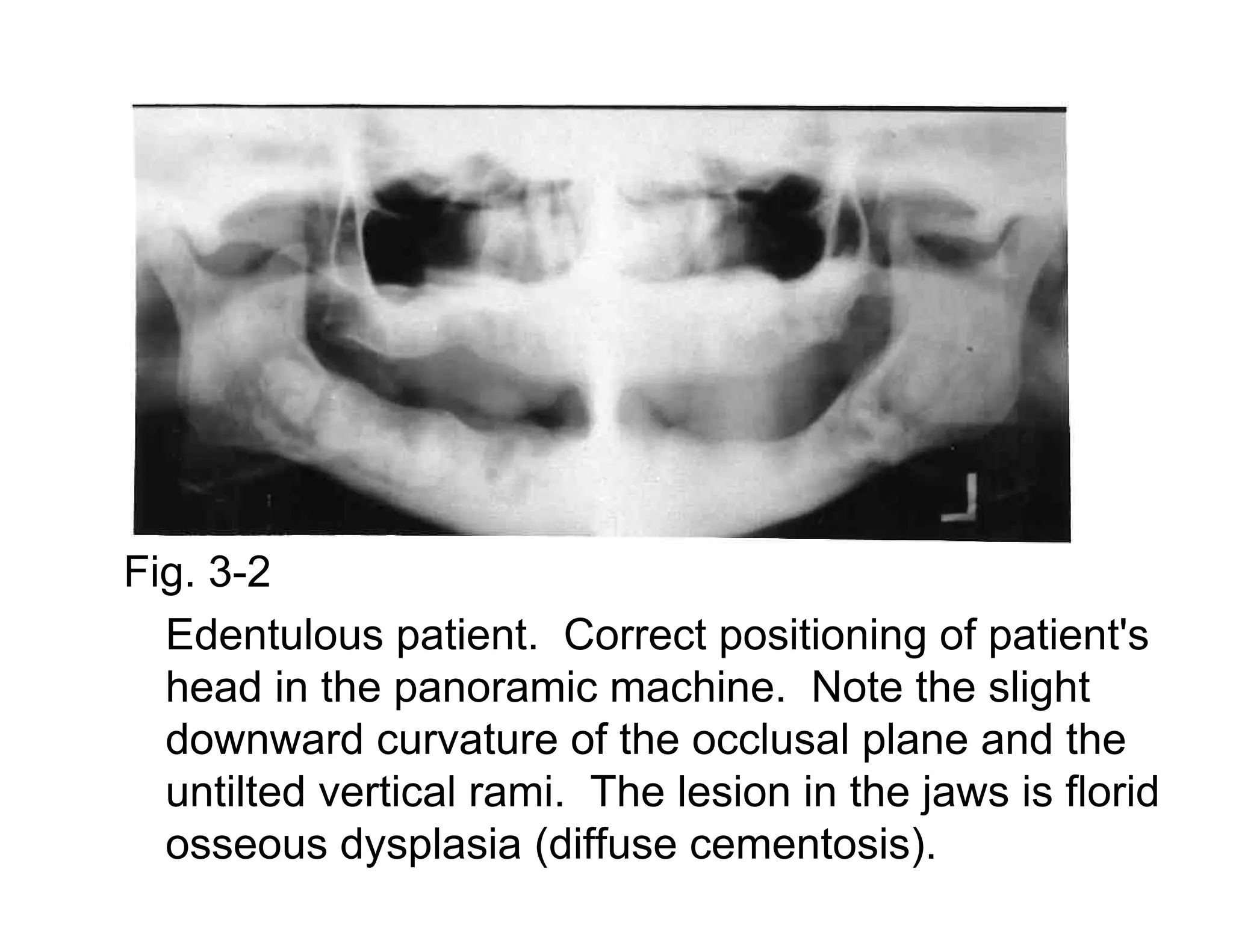 Positioning Errors in Panoramic Radiography | PDF