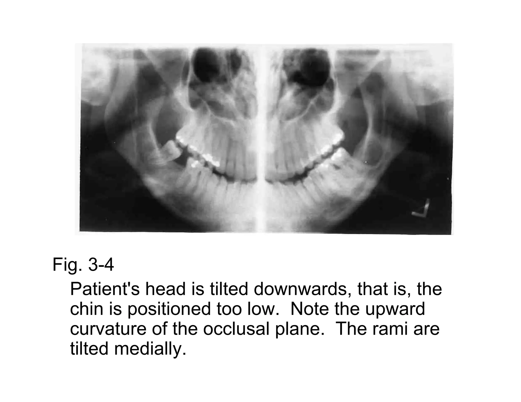 Positioning Errors in Panoramic Radiography | PDF