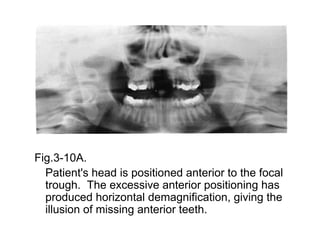 Positioning Errors in Panoramic Radiography | PDF