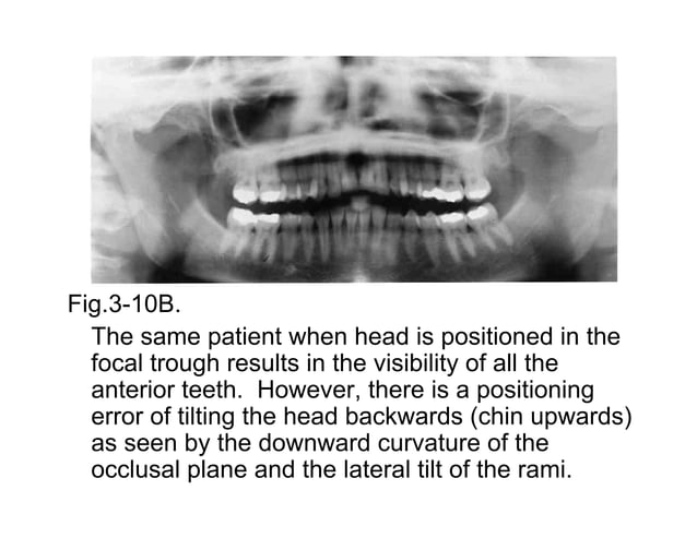 Positioning Errors in Panoramic Radiography | PPT
