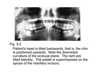Positioning Errors in Panoramic Radiography | PDF
