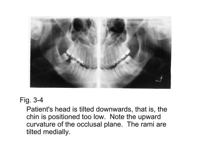 Positioning Errors in Panoramic Radiography | PPT