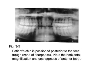 Positioning Errors in Panoramic Radiography | PDF