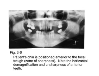 Positioning Errors in Panoramic Radiography | PDF