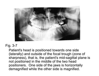 Positioning Errors in Panoramic Radiography | PDF