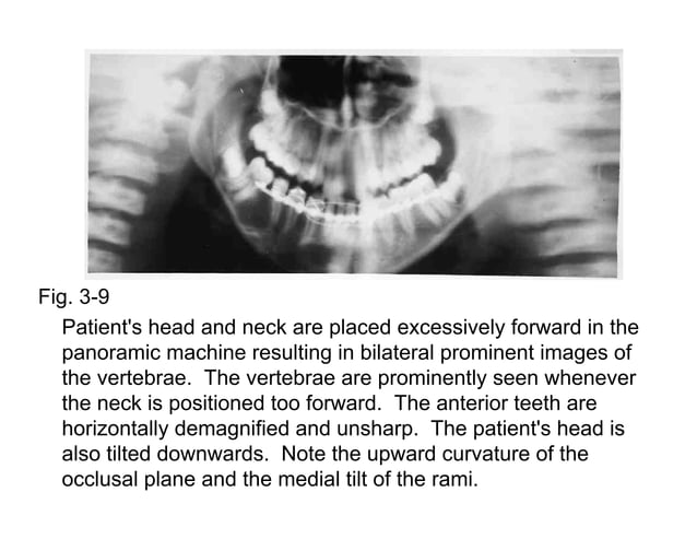 Positioning Errors in Panoramic Radiography | PPT