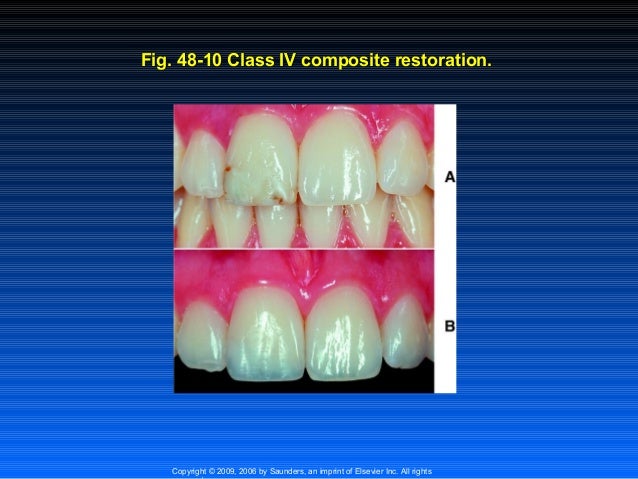 classification of cavity preparation