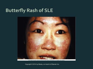 sle ins and outs elaborated in detail explained | PPT