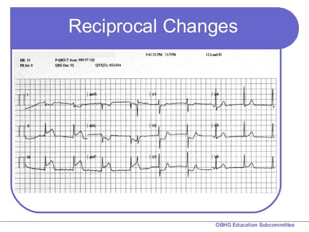 Chapter 10 - 12 lead Interpretation - Part 2