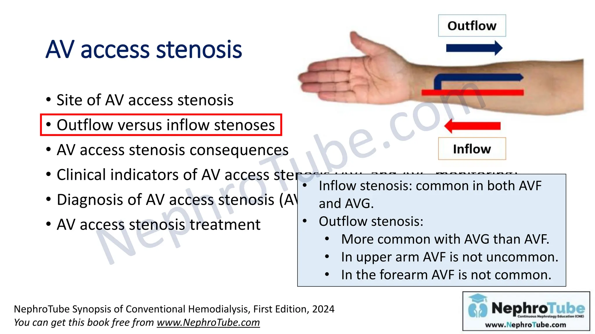 Hemodialysis: Chapter 10, AVF and AVG - Complications (Diagnosis and ...