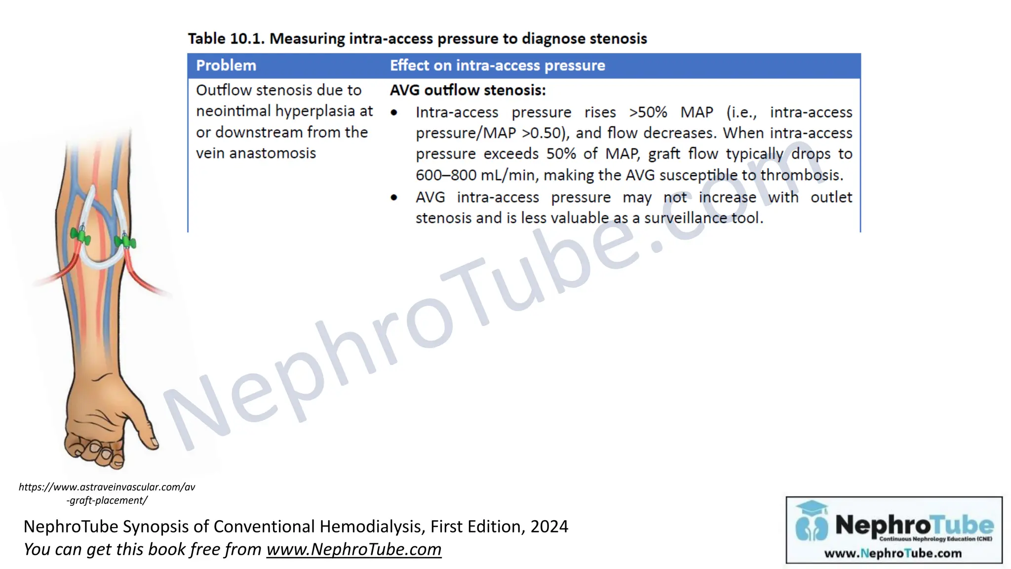 Hemodialysis: Chapter 10, AVF and AVG - Complications (Diagnosis and ...