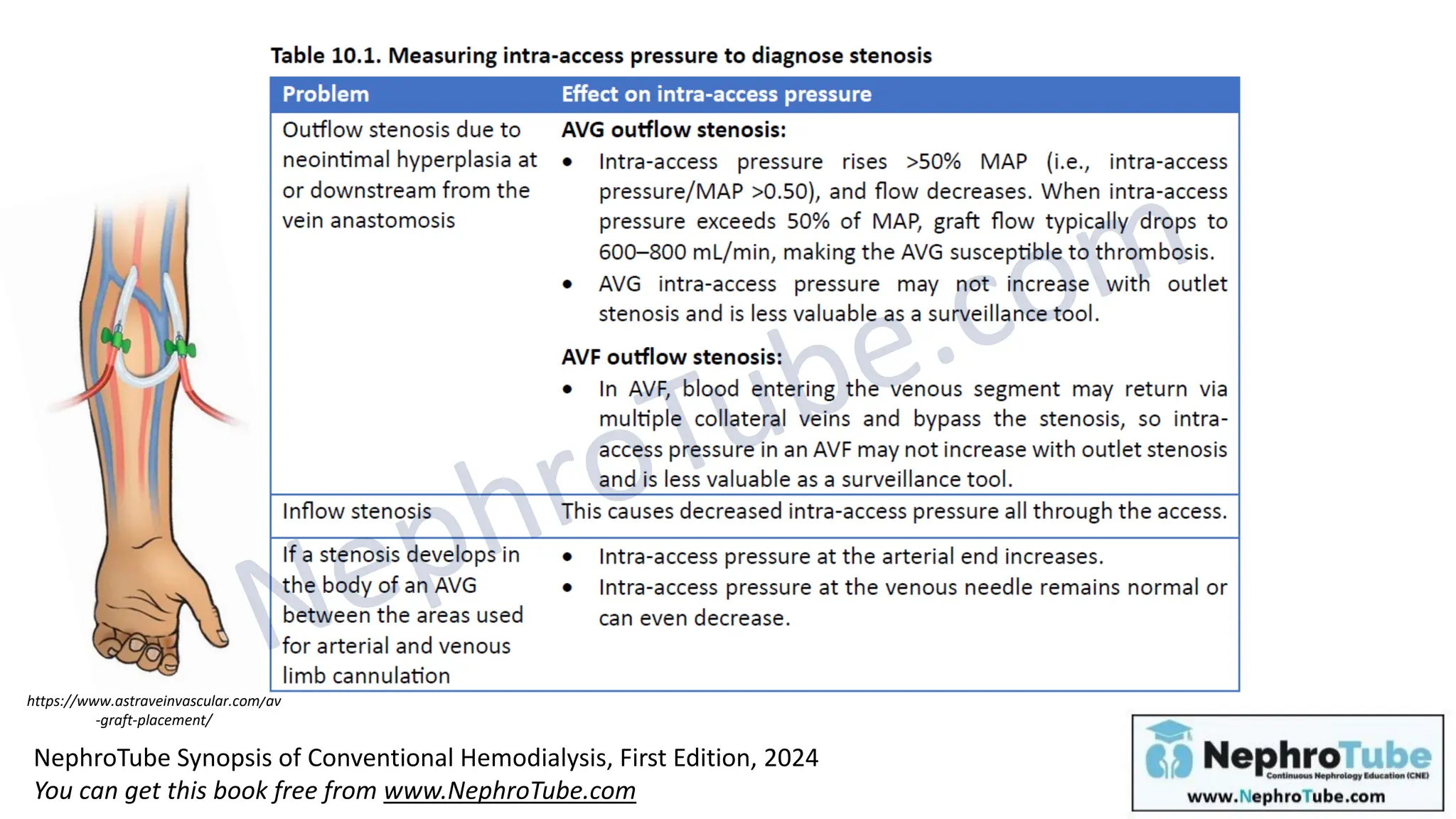 Hemodialysis: Chapter 10, AVF and AVG - Complications (Diagnosis and ...